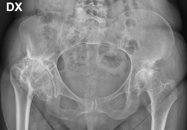 Displasia congenita dell’anca, come mantenere una buona articolarità ...