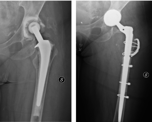 Revisione protesi anca? Sì se la protesi è malfunzionante – Dr. Paolo ...