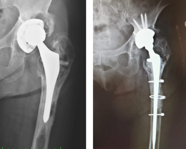 Revisione protesi anca? Sì se la protesi è malfunzionante – Dr. Paolo ...